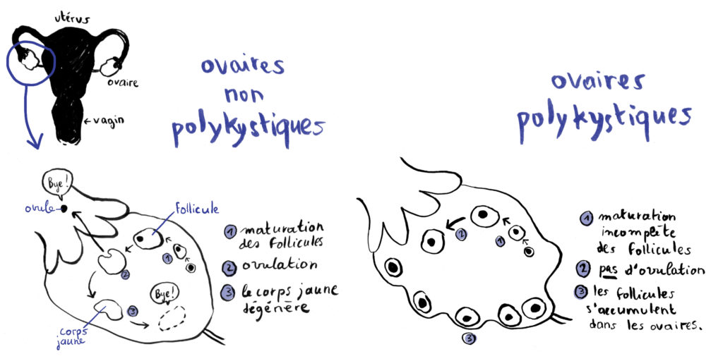 Le SOPK (syndrome des ovaires polykystiques) – J'aime ma vulve